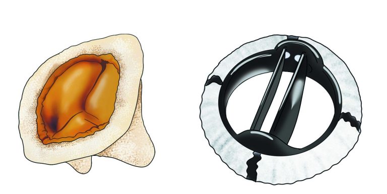 Patient information - British Heart Valve Society