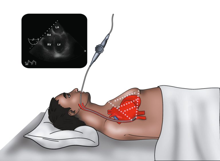 Transoesophageal echocardiogram (TOE) - British Heart Valve Society