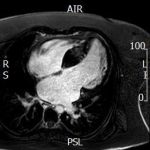 Cardiac magnetic resonance scan (CMR / MRI scan) - British Heart Valve ...