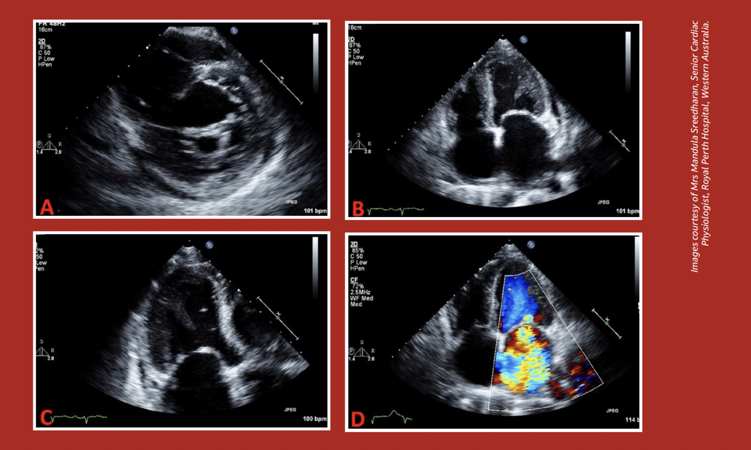 BHVS - British Heart Valve Society